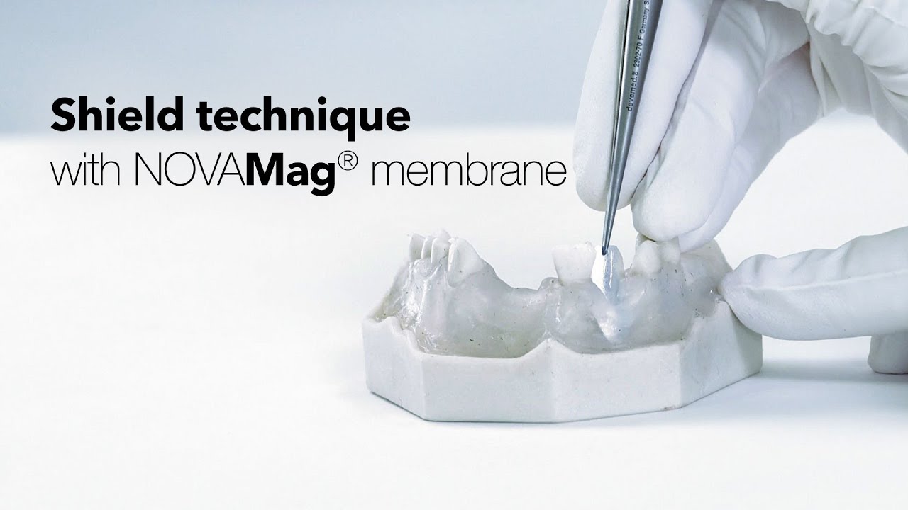 Shield technique with NOVAMag® membrane