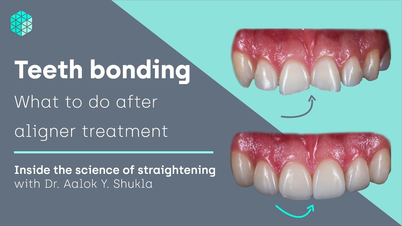 Teeth bonding - what to do after aligner treatment | Inside the science of teeth straightening