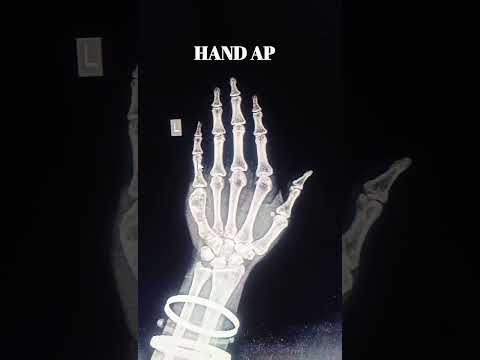 Bone Tumour Hand Xray : ENCHONDROMA #bones #tumour #radiology #orthopedicsurgeon #xray #medicine