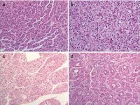 Compact Hepatocellular carcinoma ; Definition, Histology, Symptoms, Diagnosis, Treatment