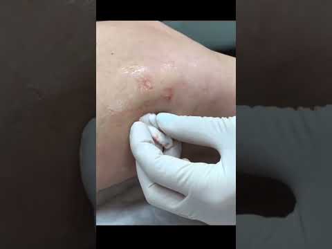 Dr Pimple Popper Performs Sclerotherapy #shorts