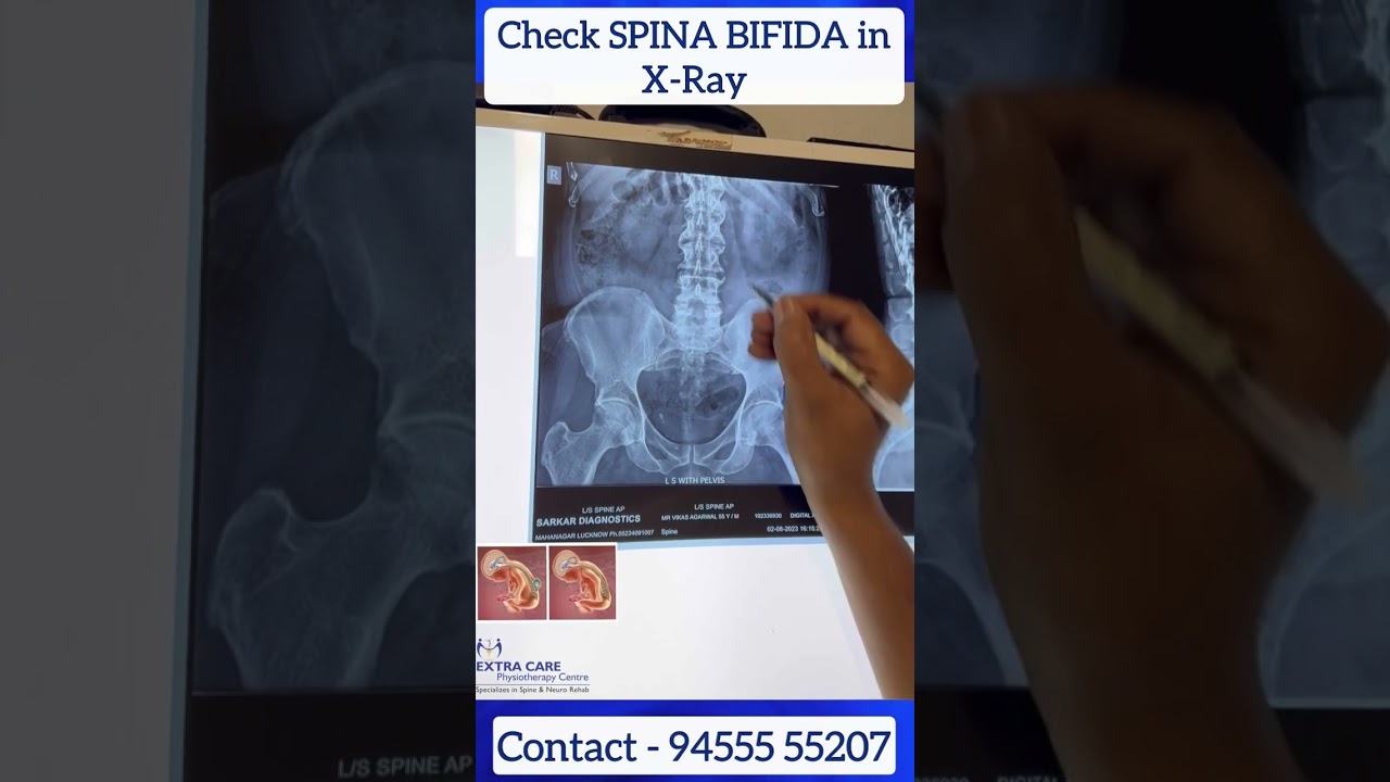 Self check Spina Bifida in X-ray | #extracarephysiotherapy