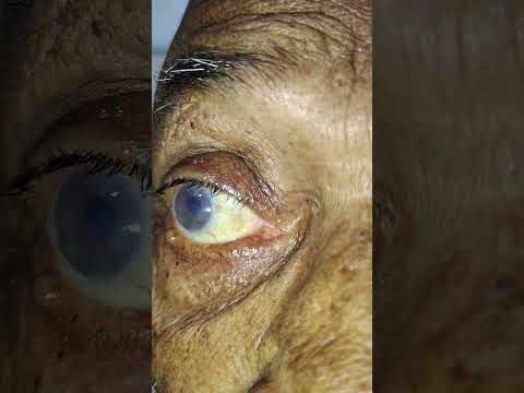pseudophakic Bullous keratopathy (PBK)