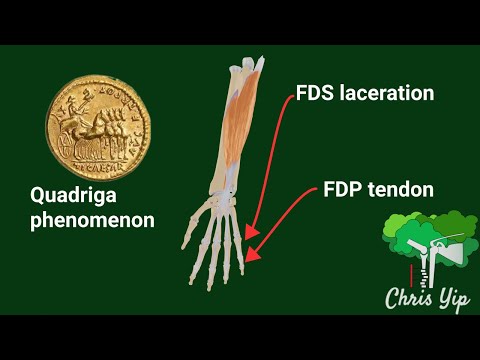 Flexor tendon injuries and the Quadriga Phenomenon (animated)