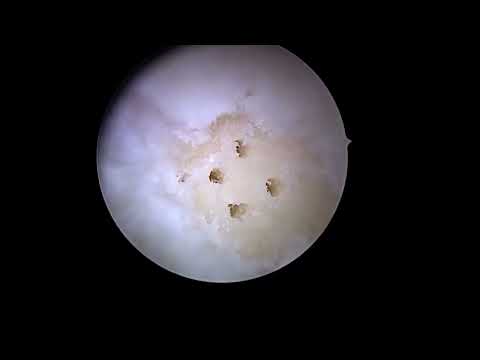 Arthroscopic matrix augmented bone marrow stimulation