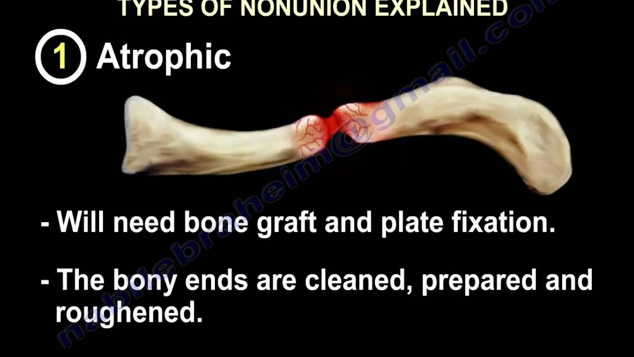 Nonunion Of The Clavicle - Everything You Need To Know - Dr. Nabil Ebraheim
