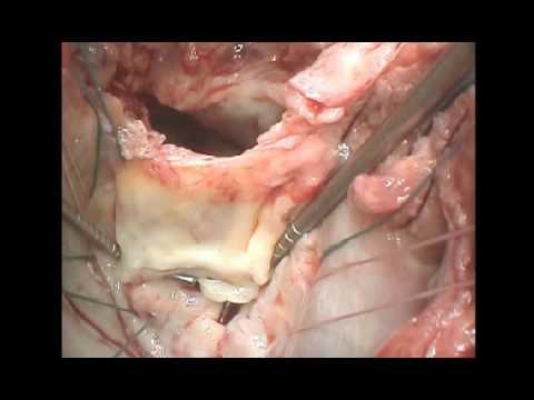 Incorporated Aortomitral Homograft for Double Valve Endocarditis: The Hemi-Commando Procedure
