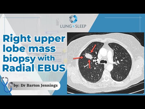 Radial endobronchial ultrasound bronchoscopy to biopsy a lung cancer