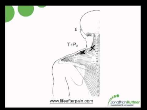 Trigger Points Defined