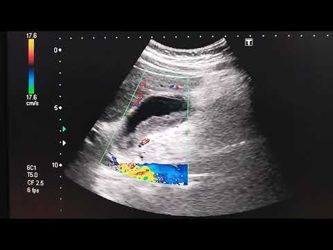 Gallbladder sludge by Medical Radiology