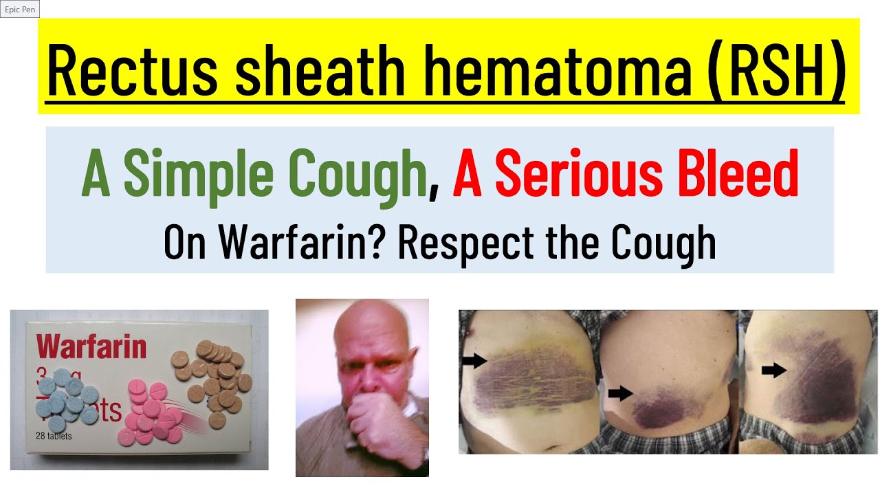 Rectus Sheath Hematoma Explained | Warfarin, Cough & Abdominal Pain