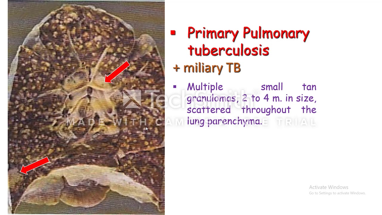 Miliary Tuberculosis
