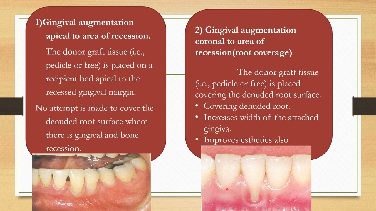 Mucogingival Problems  1 & 2