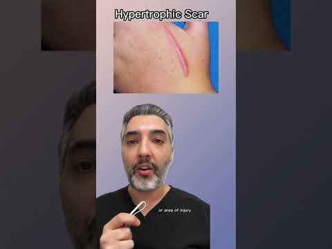 Hypertrophic vs Keloid Scars: What's the Difference and How to Treat Them