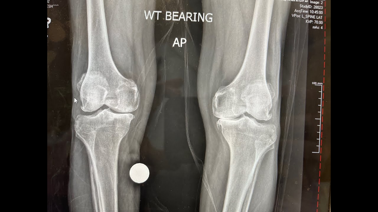 Osteoarthritis on Xray