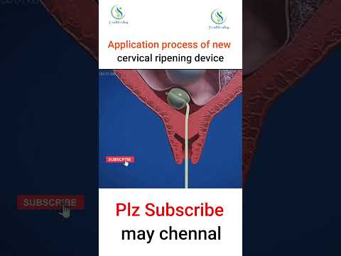 Application process of new cervical ripening device #pregnancy #pregnant #fetus #babyboy