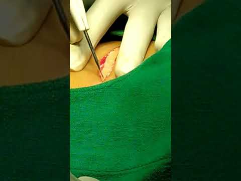 pfannenstiel incision for lower abdomen