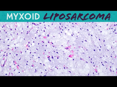 Myxoid Liposarcoma (explained in 5 minutes) basic soft tissue pathology sarcoma pathologists