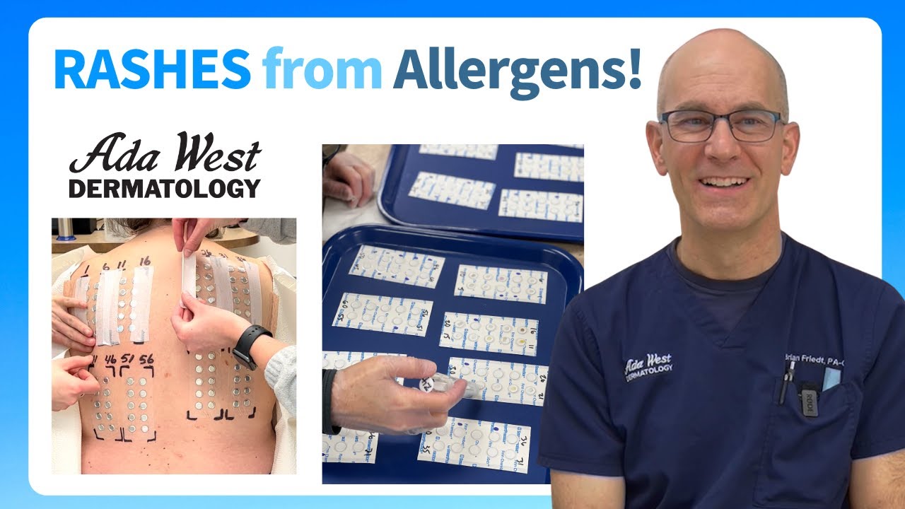 Patch testing for skin allergy in Boise with Ada West Dermatology