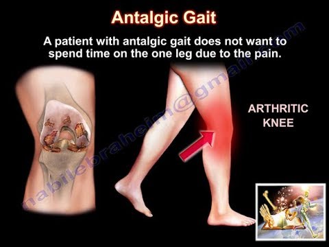 Painful Gait, Antalgic Gait - Everything You Need To Know - Dr. Nabil Ebraheim