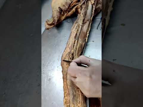 Median Cubital vein, Cephalic Vein, Basilic Vein, Bicipital Aponeurosis, Brachial Artery