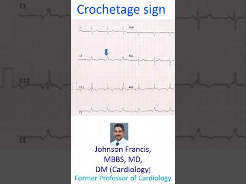 Low atrial rhythm and Crochetage sign