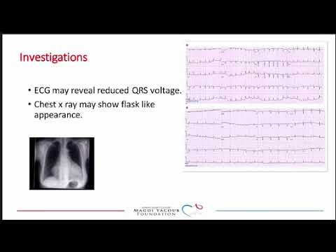 Pericardial Effusion and Cardiac Tamponade, diagnosis and management. Dr. Hassan Fat'hy