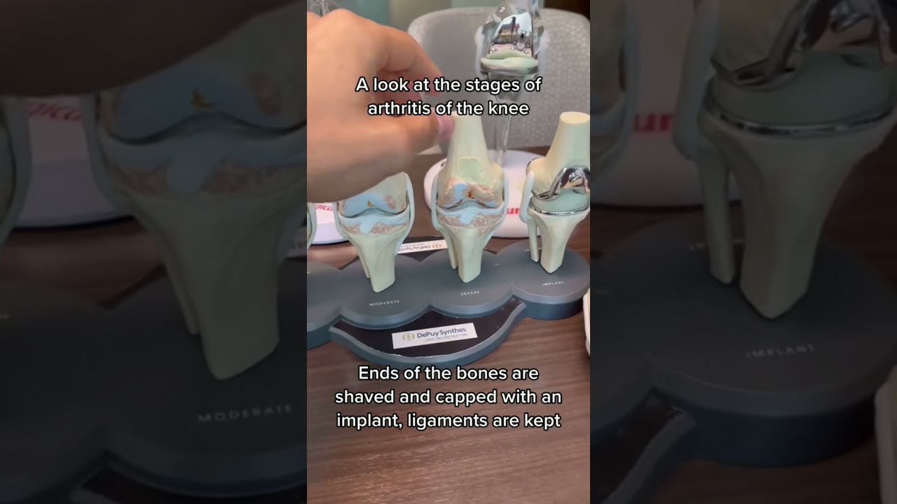 Knee replacement for arthritis