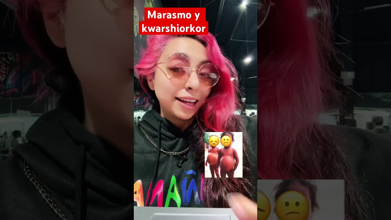 Desnutrición marasmo y kwarshiorkor #desnutrición #malnutrition