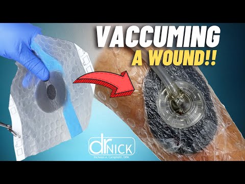 How To Apply A Wound Vac!