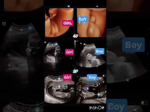 Baby boy and baby girl ultrasound