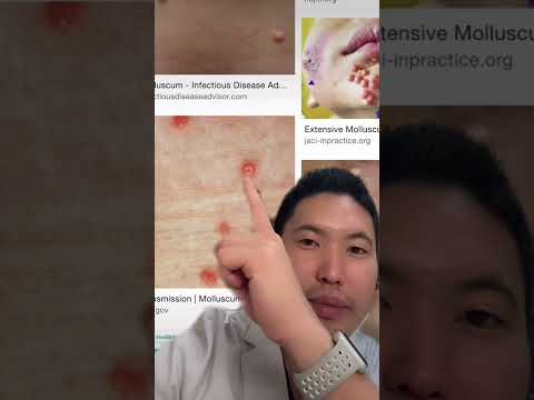 #shorts Molluscum contagiosum: what are these bumps on my kid?