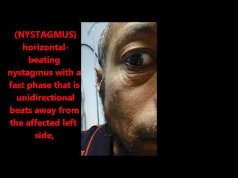 HINTS test//how to differentiate vestibular neuritis and central vertigo