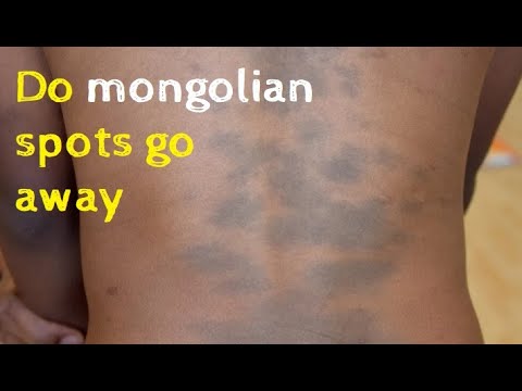 do mongolian spots go away