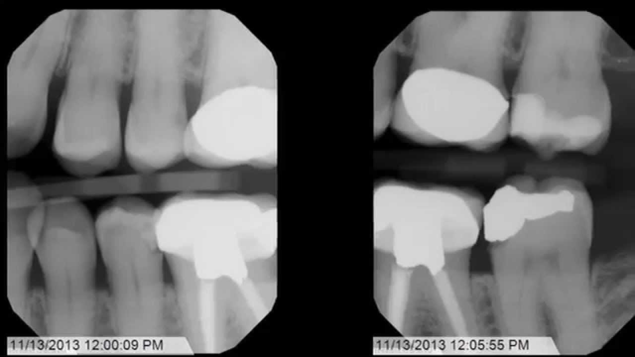 Tips and Tricks for Bitewing X-Rays