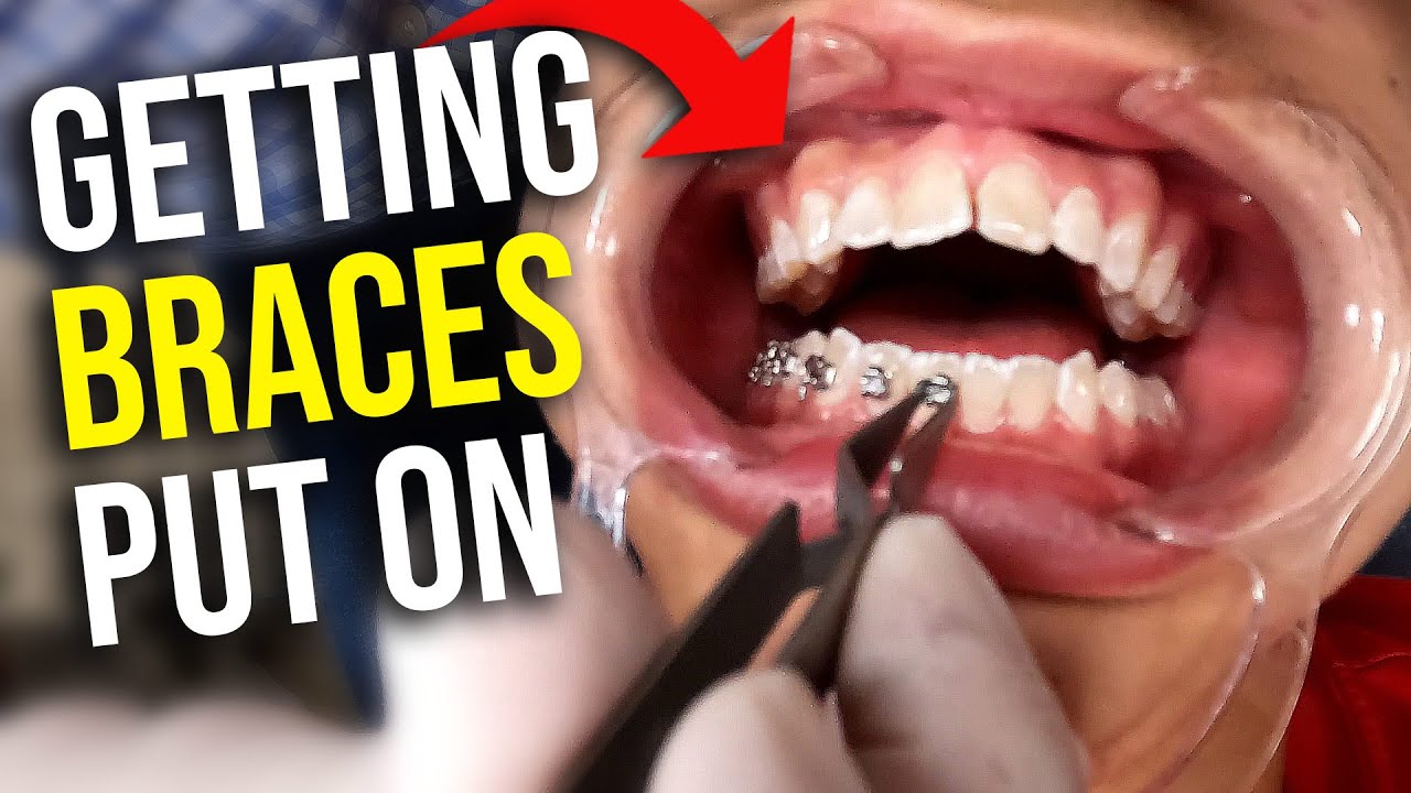 How BRACES are put on (Step-by-Step Process)
