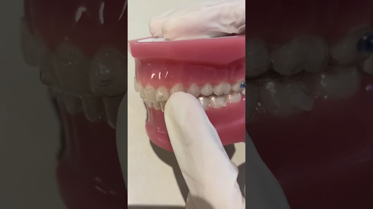 Class II Elastics with Invisalign