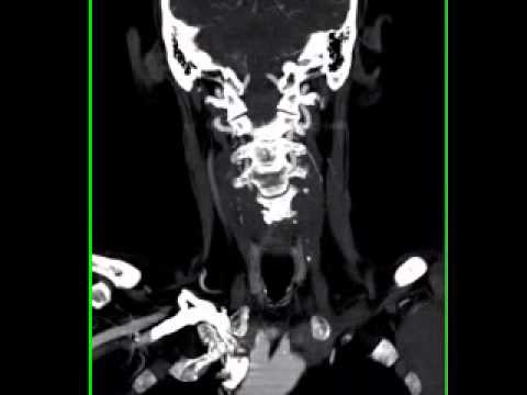 Visual claudicatio: diagnosis with 64-slice computed tomography