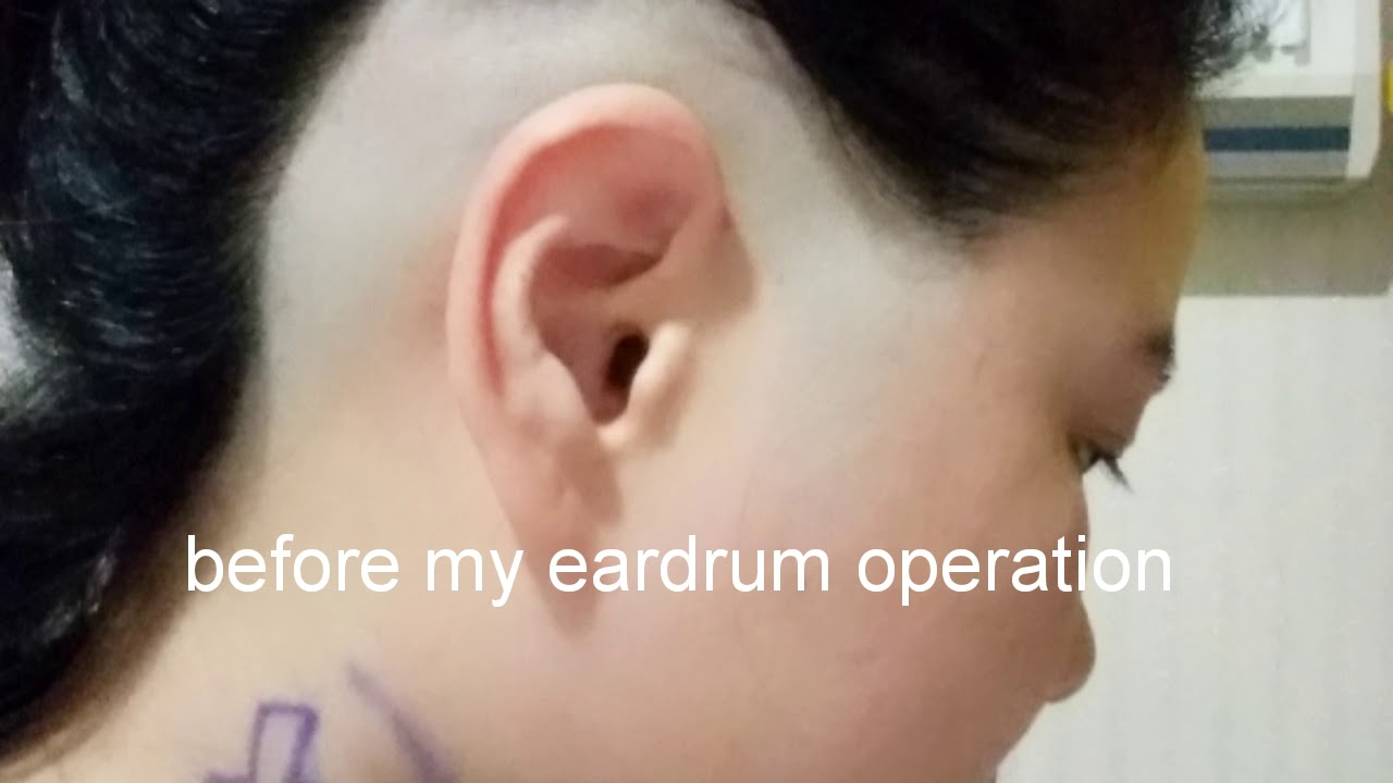 NA OPERAHAN SA EARDRUM