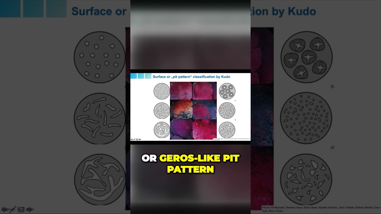 Cracking the Code: Unveiling Polyp Patterns in Colonoscopy