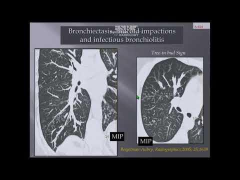 Lung and Airway Disease by HRCT - Basic Radiology