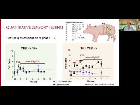 Viola Rieke: MRgFUS of the Dorsal Root Ganglion for the Treatment of Low Back Pain