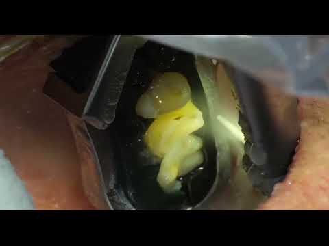 Would You Let a Robot Dentist Work on Your Teeth? - 100.5 KWIQ