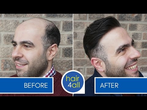 hair4all Client & Consultant Mou chats about wearing a Hair Replacement System for Men - Part 1