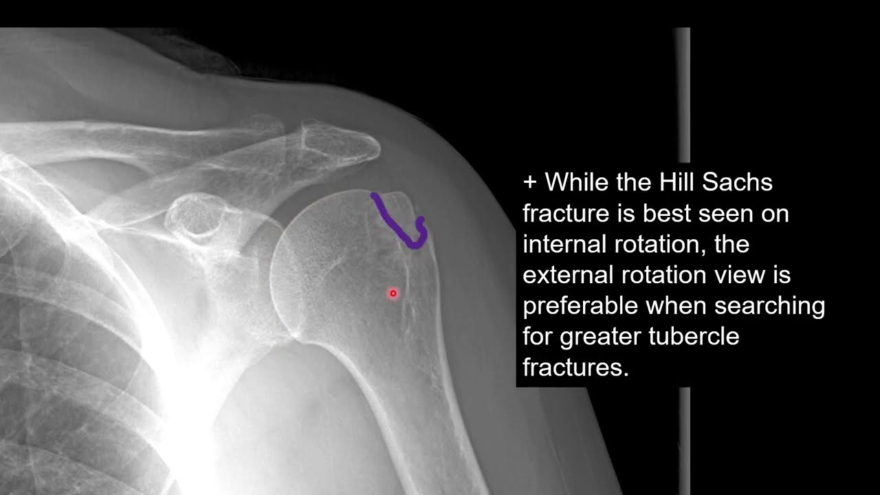 Shoulder X-Ray: Trauma