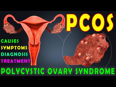 Polycystic Ovary Syndrome (PCOS) - Causes, Risks and Treatments | EVA MEDICAL SERIES