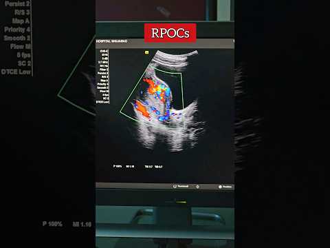 Retained Products of Conception | RPOCs | Failed Pregnancy 💔 #pregnancy #ultrasound #health #medical