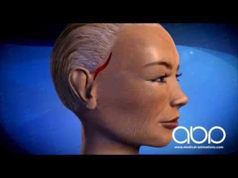 Face Lift