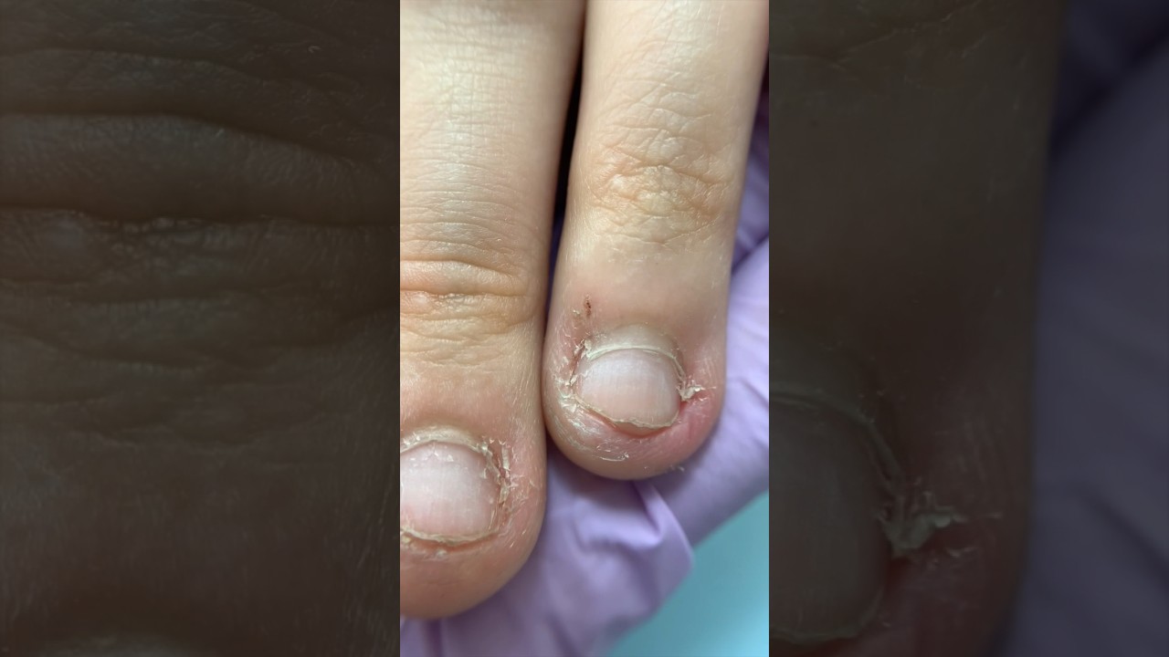 Extreme Bitten Nails Transformation ✨