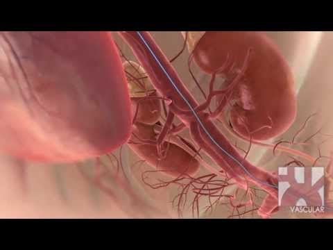 Red Vascular Branch Endograft System: Aortic Aneurysm